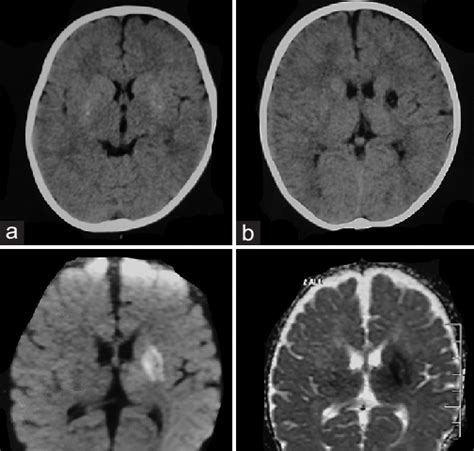 Ncct Brain Shows Punctate Linear Hyperdensities Along Bilateral Download Scientific Diagram