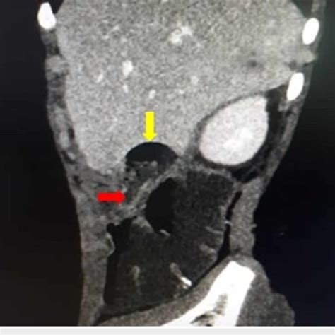 Figure Double Barreled Appendix Cave Wallbridge Classification Type A