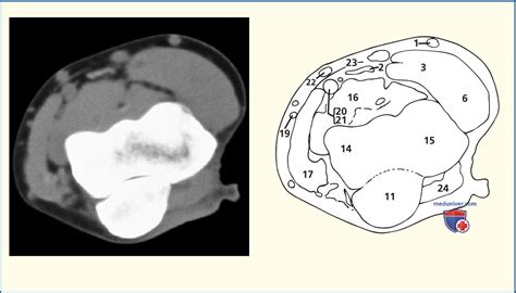 Анатомия аксиального среза локтя через локтевой сустав