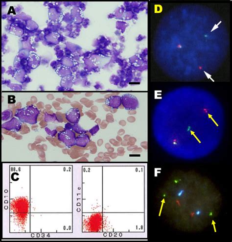 Double Hit Lymphoma Mimicking B Cell Precursor Phenotype Burkitt Lymphoma Leukemia In An Elderly