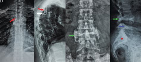 Thoracolumbar Spine Radiography Showed Thoracic Spine Deformation With