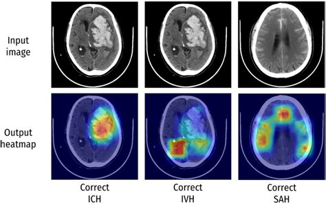 Evaluation Of Techniques To Improve A Deep Learning Algorithm For The Automatic Detection Of
