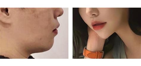 파워v얼굴지방흡입이중턱 볼밑 심부볼 실리프팅4줄씩 침샘보톡스 후기 닥터정 리반의원