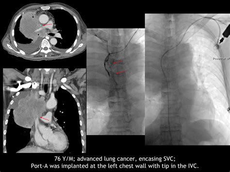 Tip 放到 IVC 裡的 Port A Tsai I ta Blog