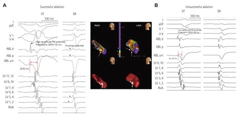 Local Bipolar Electrogram Unipolar Electrogram And Three Dimensional Download Scientific