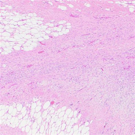 IgG Immunohistochemistry On Sclerosing Peritoneal Lesion Download
