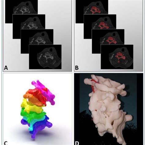 3d Model Reconstruction Of The Pre Operative Cervical Spine Dicom Download Scientific Diagram