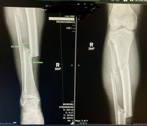 Segmental Fractures Of The Tibia R Radiology