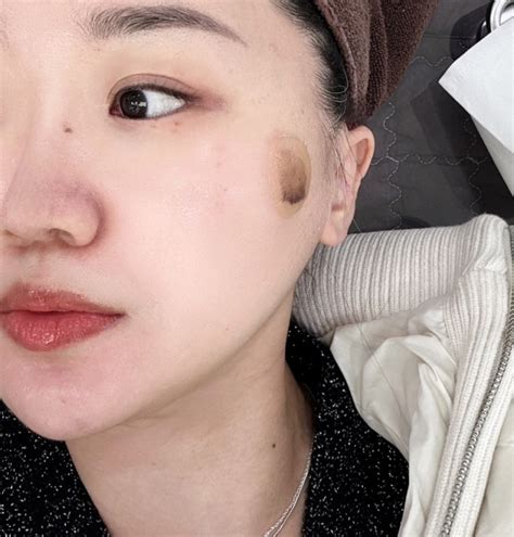 신논현역피부과 백자 리팟 레이저 흑자제거 후기 2탄 비용 관리법 네이버 블로그