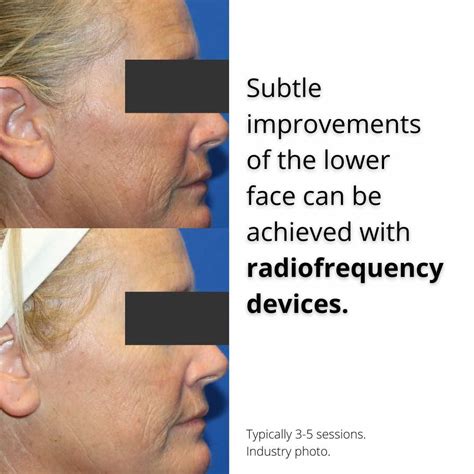 Threading For Jowls Cost At Harvey Horton Blog
