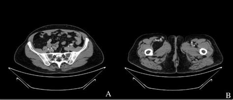 A It Is Observed An Encapsulated Lesion With Fatty Attenuation With Download Scientific