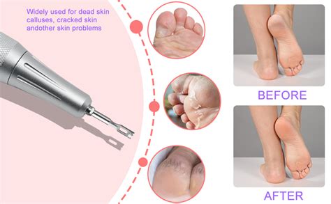 Vnjaoi Stainless Steel Corn Remover Drill Bit Medical