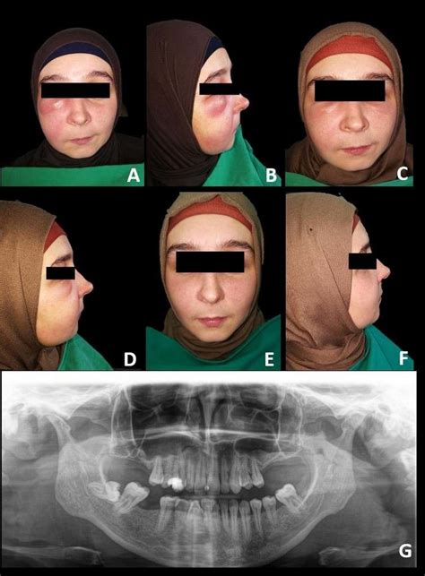 Premaxillary Abscess After The Initiation Of Endodontic Treatment Of