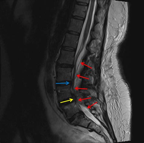 Spinal Epidural Hematoma Treatment Quotes Welcome Vrogue Co