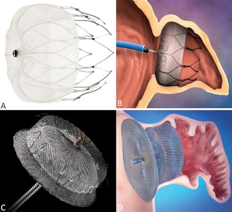 Currently Available Left Atrial Appendage Closure Devices A And B