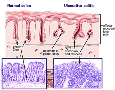 Mbbs Medicine Humanity First Inflammatory Bowel Diseases