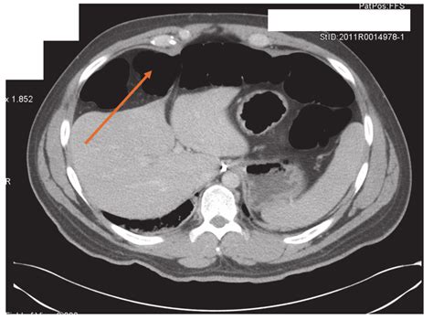Chilaiditis Syndrome—what Every Endoscopist Should Know