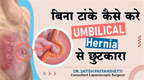 Anatomy Of Umbilical Hernia Abdominal Hernias Practice Essentials