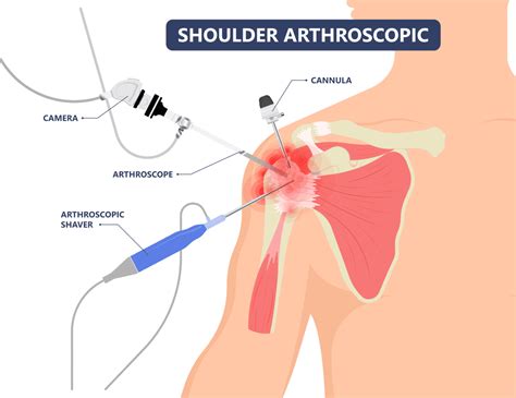 Subacromial Bursitis Causes Symptoms And Treatments