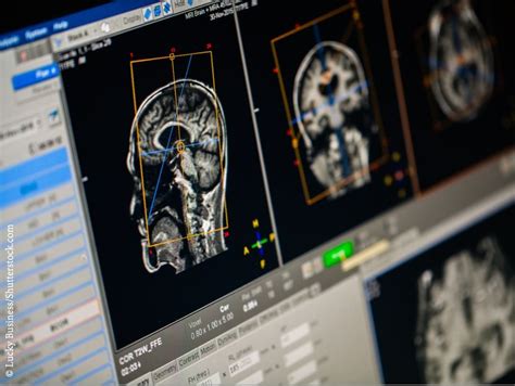 New Developments In EEG Brain Scans Could Help Spot Mental Disorders Early Psychiatric Times