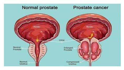 Diseases Of The Prostate Gland Paulapptx