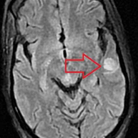 Cranial Mri Showing Left Temporal Hyperdensity In T2 Sequence Red