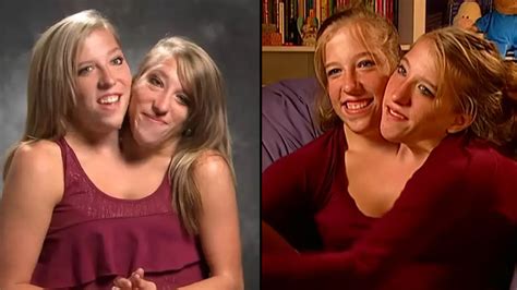 Conjoined Twins Separated
