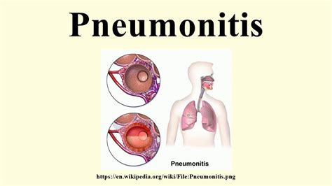 Pneumonitis Youtube