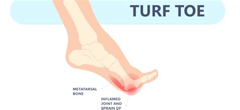 How To Treat Turf Toe At Home At Nicholas Olson Blog
