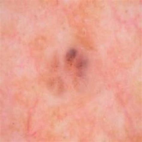 Skin Disease Classification Kaggle