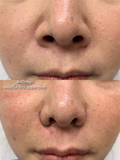 ปัญหาเรื่องจมูกของคนไทย คลินิคศัลยกรรมความงาม โดย หมอเปิ้ล
