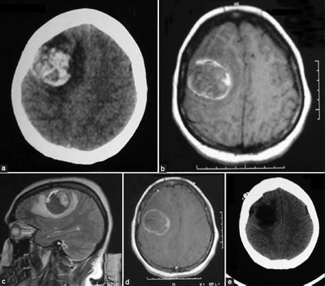Supratentorial Primitive Neuroectodermal Tumor Presenting With Intracranial Hemorrhage In Adult