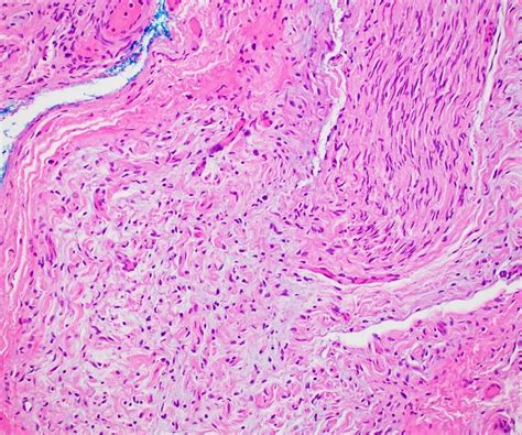 Neurofibroma Wikipedia