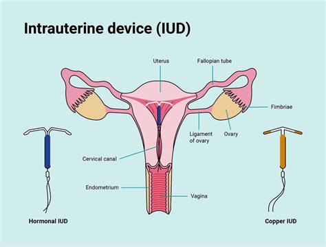 Intrauterine Devices Insertion Parkmore Medical Centre