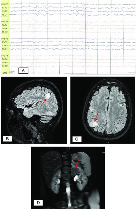Electroencephalogram Showed Diffuse Epileptiform Abnormalities On The