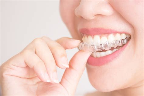 The Benefits Of Clear Dental Aligners For Adults