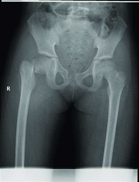 Fracture Classification And Displacement Degree Radiograph Showing A