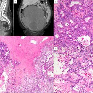Preoperative CT Scan Coronal View Showing A Large Pelvic Mass