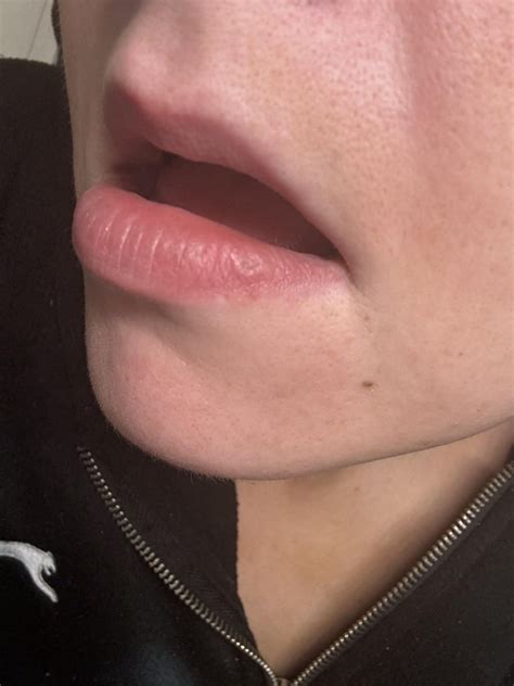 Could This Be A Wart On My Lip Roralhpv