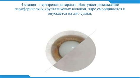 Заболевания сосудистого тракта хрусталика стекловидного тела роговицы и склеры презентация