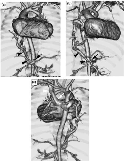 Preoperative Multidetector Row Computed Tomography A Anterior View Download Scientific