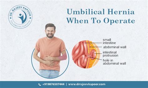 Umbilical Hernia Repair A Comprehensive Guide Dr Rajeev Kapoor