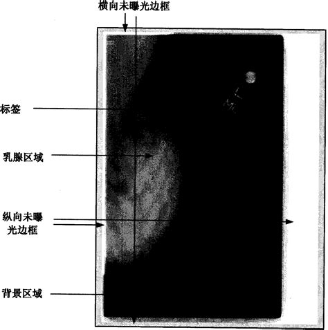 Preprocessing Method For Breast Region Extraction In Breast Molybdenum