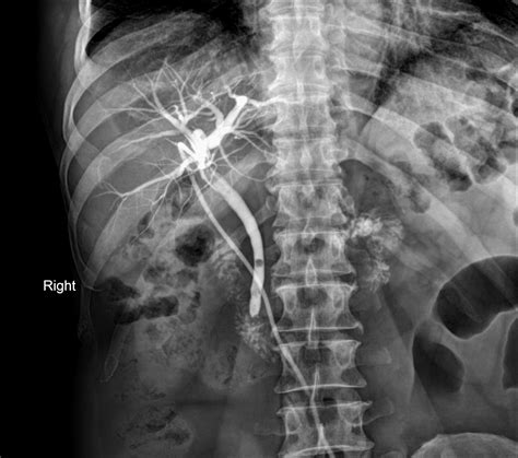 Choledocholithiasis T Tube Cholangiography Image