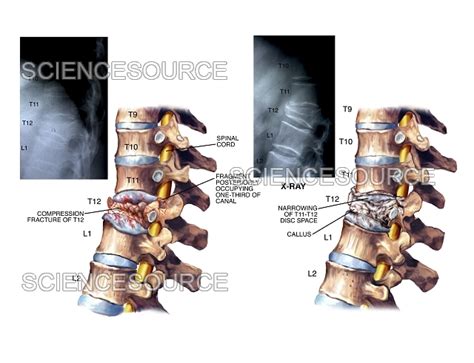 Compression Fracture Of Thoracic Verte Stock Image Science Source Images