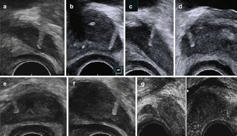 Fiducial Marker Implantation In Prostate Radiation Therapy Abdominal Key