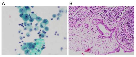 Mesothelioma Cytology