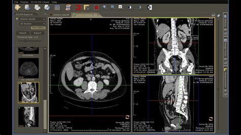 Weasis Dicom Viewer Free Download Neryrt