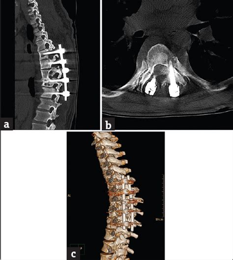 Evaluation Of Orthopedic Metal Artifact Reduction Application In Three Dimensional Computed