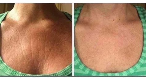 Ipl Treatment In Houston Refresh Dermatology